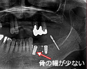 骨が足りない時に役立つGBR（骨造成）の手法とは？｜東京都江戸川区篠崎