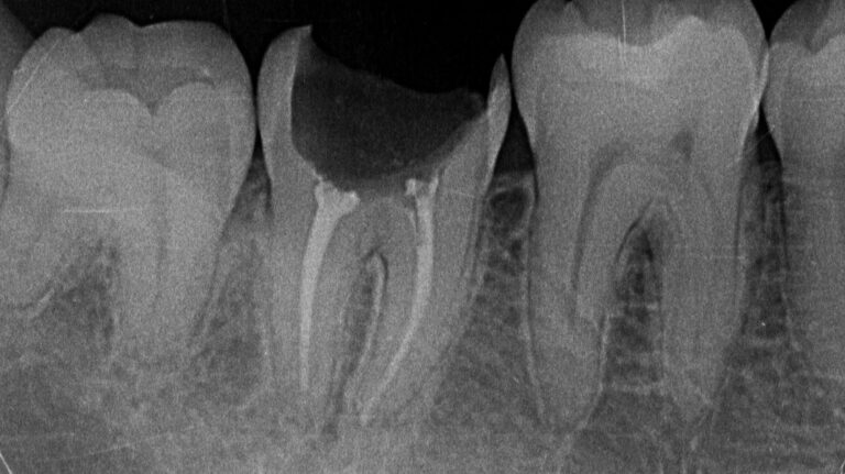 【虫歯の進行速度】どれくらい早い？CO・C1・C2・C3の進行段階を徹底解説