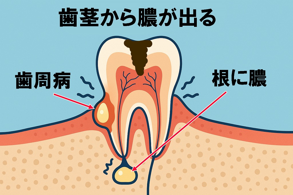 歯茎から膿が出る原因は歯周病？根の感染？歯科医が正しい対処法を解説